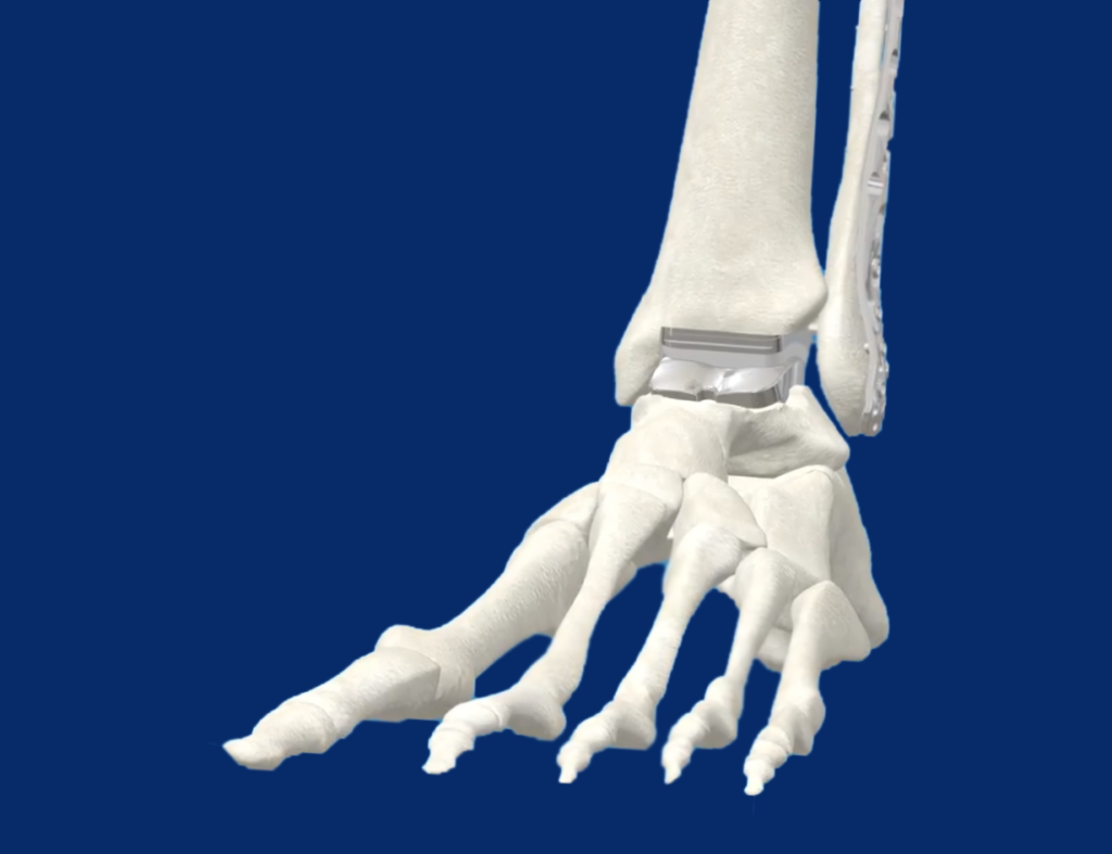 Artroplastia gleznei (proteza de gleznă) – Cum poate fi glezna ...
